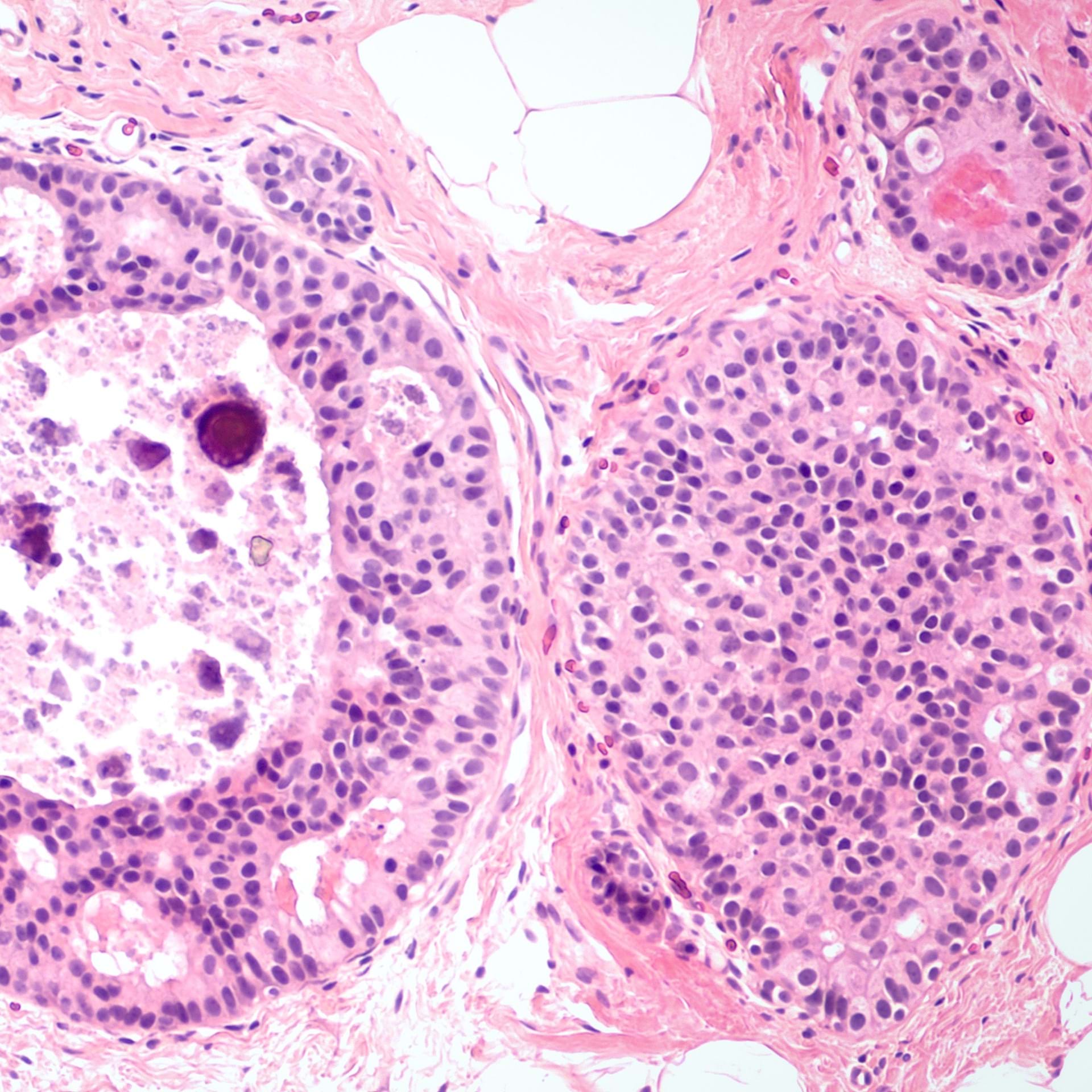 Presisjonsdiagnostikk for brystkreft – ny løsning for ESR1-mutasjoner ...